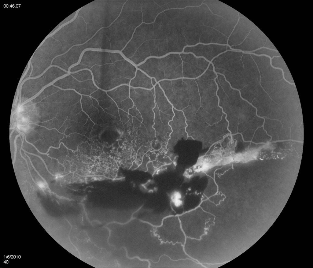 Vein Occlusions | What are BRVO and CRVO? | Retinal Specialist 92660