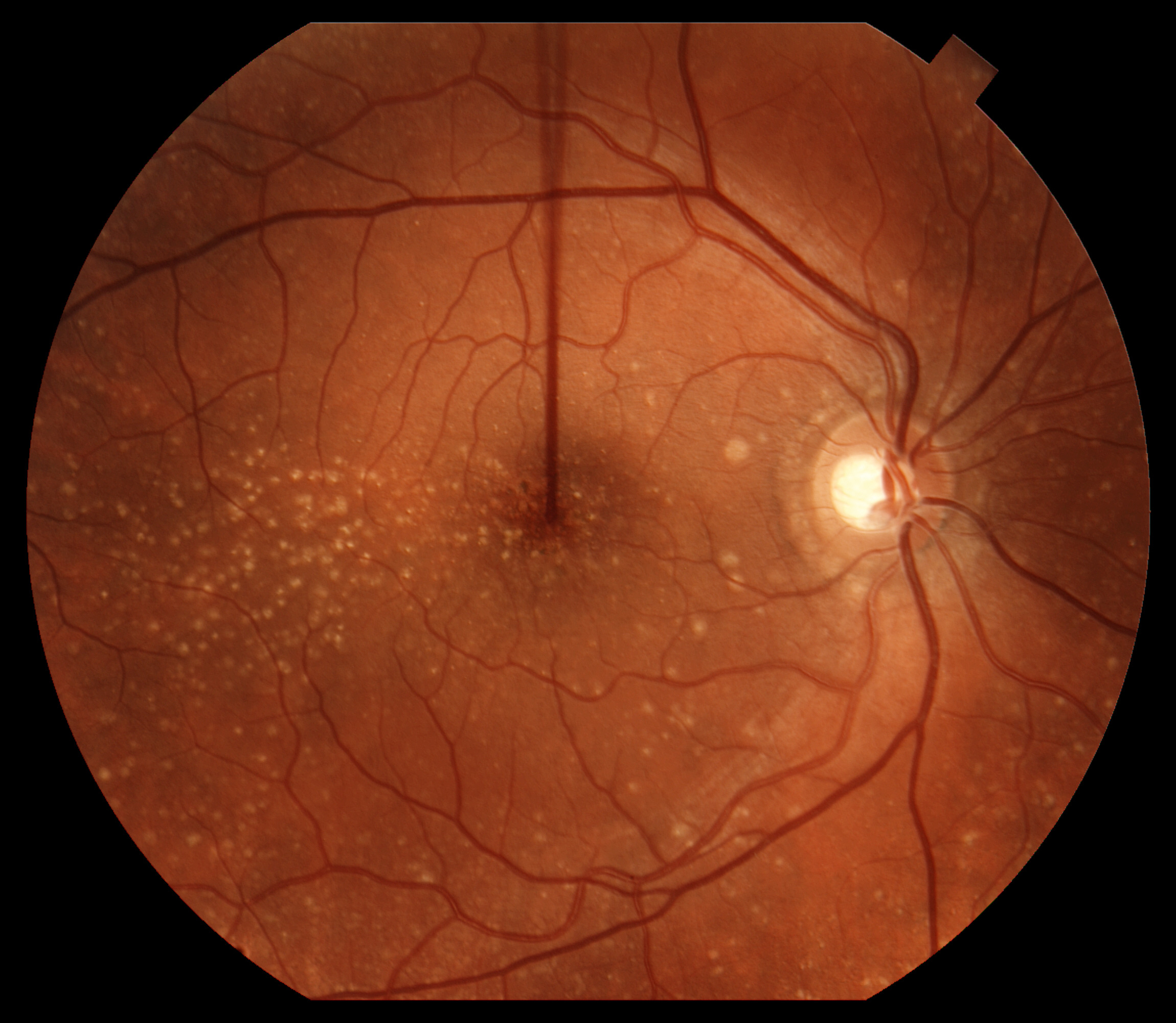 What Is Macular Degeneration | Treatments for ARMD
