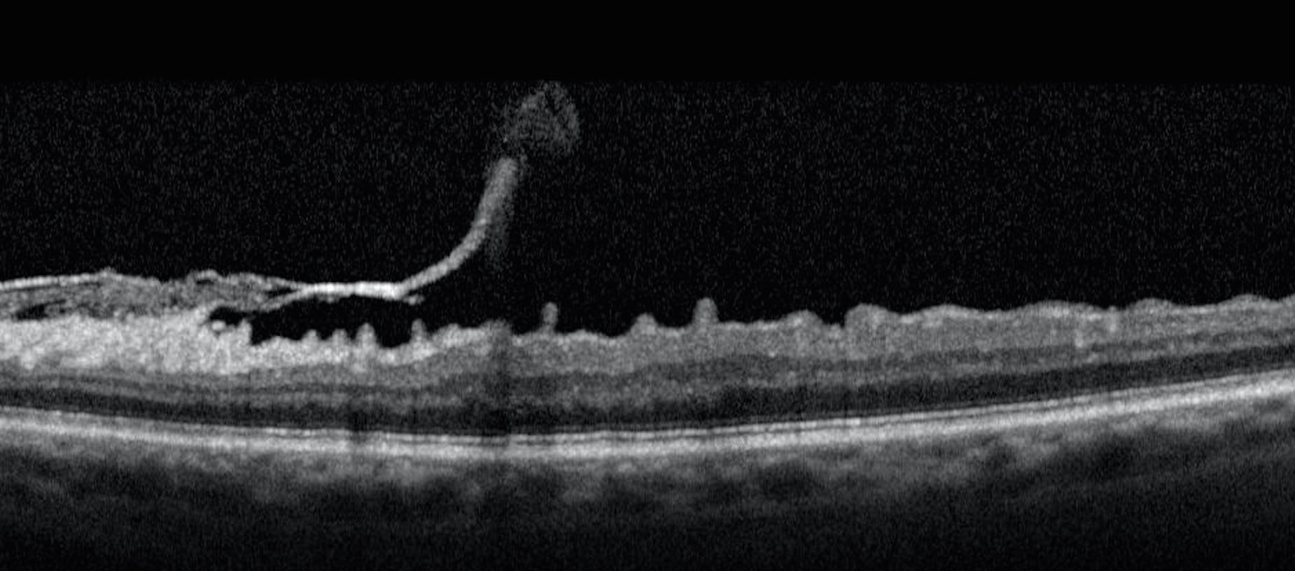 Macular Pucker Surgeon in Orange County | Newport Retina 949.427.2020