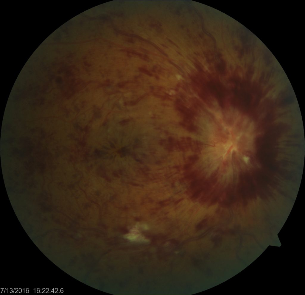 What are retinal vascular occlusions (RVO)? | Signs Symptoms of RVO
