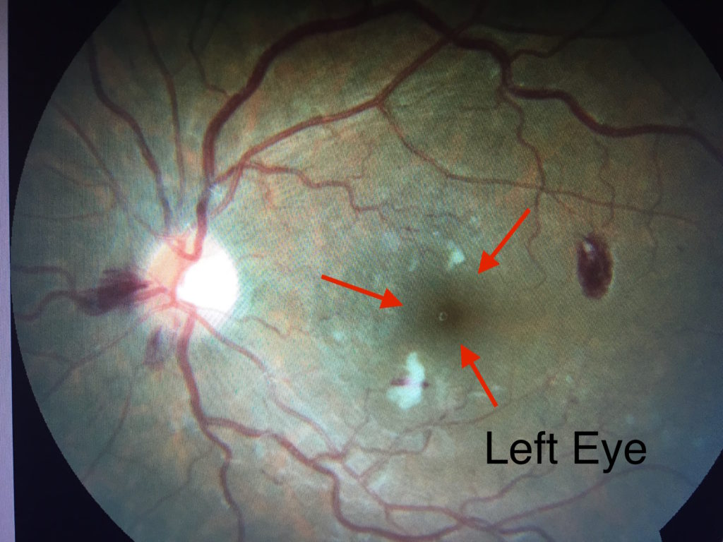 Leukemia Archives - Retina Specialist Orange County