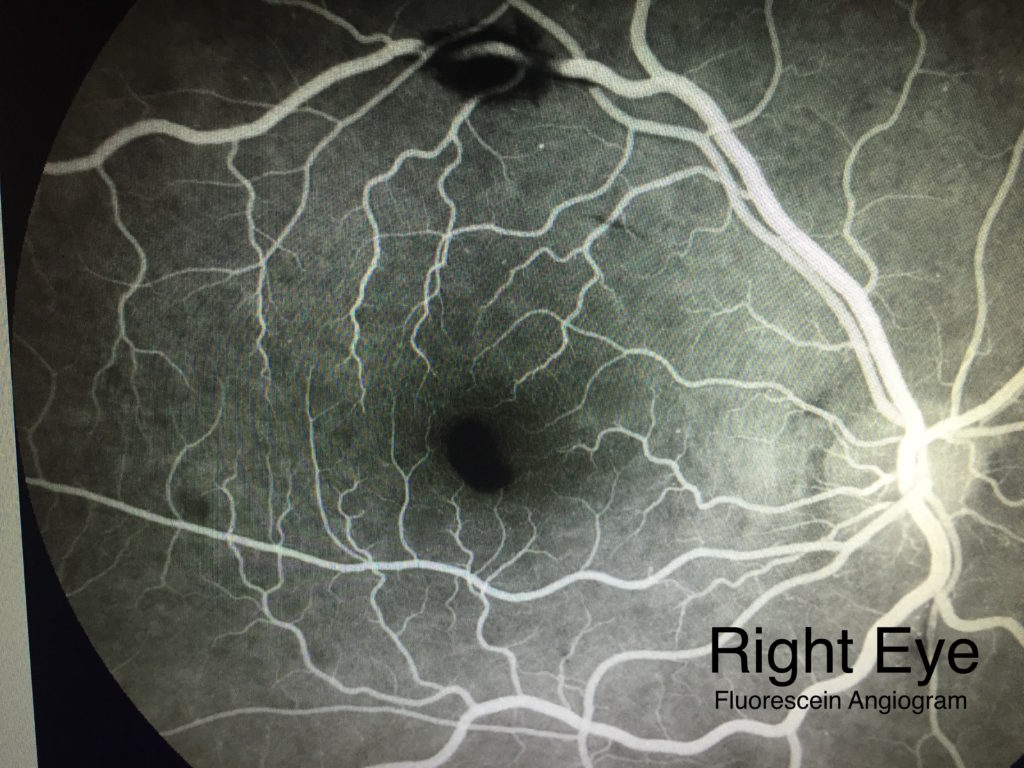Sudden Loss of Vision From Acute Leukemia | Newport Retina