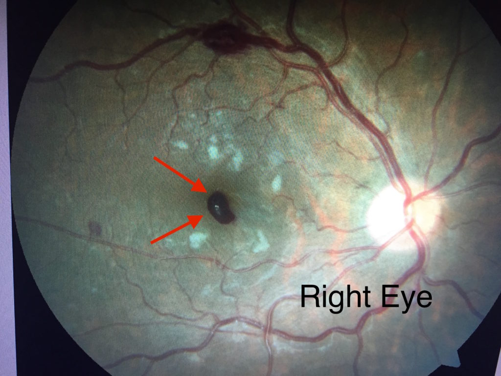 Sudden Loss of Vision From Acute Leukemia | Newport Retina