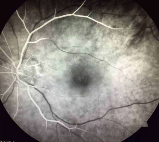 Retinal Artery Occlusion | Diagnosis and Treatment